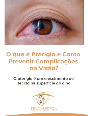 O que é Pterígio e Como Prevenir Complicações na Visão? - Dra. Caridad Vega